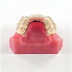 Different Splints Used to Treat TMJ