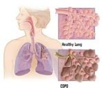 COPD: The Final Stages