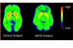 What Does ADHD do the Brain? The Results of Research and Brain Scan Imaging
